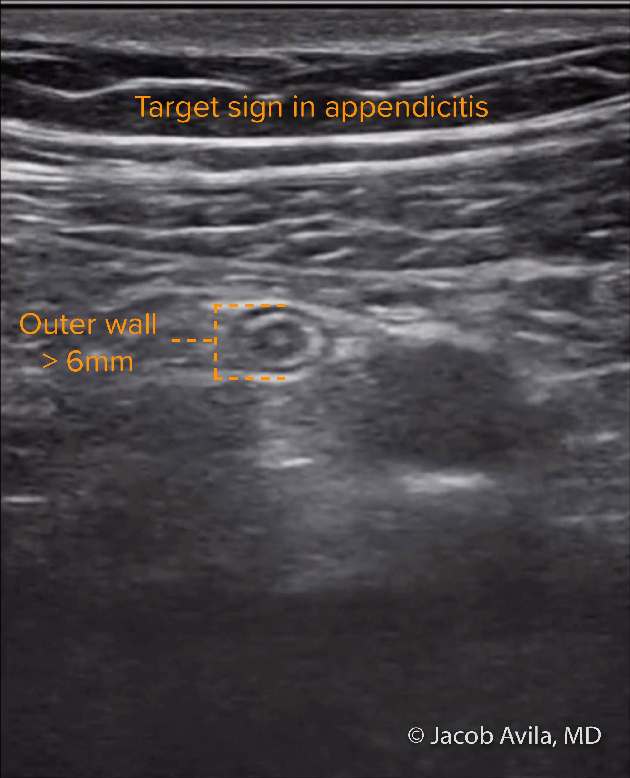 Crunch Time EM - Appendicitis in Pediatric Patients | EM:RAP