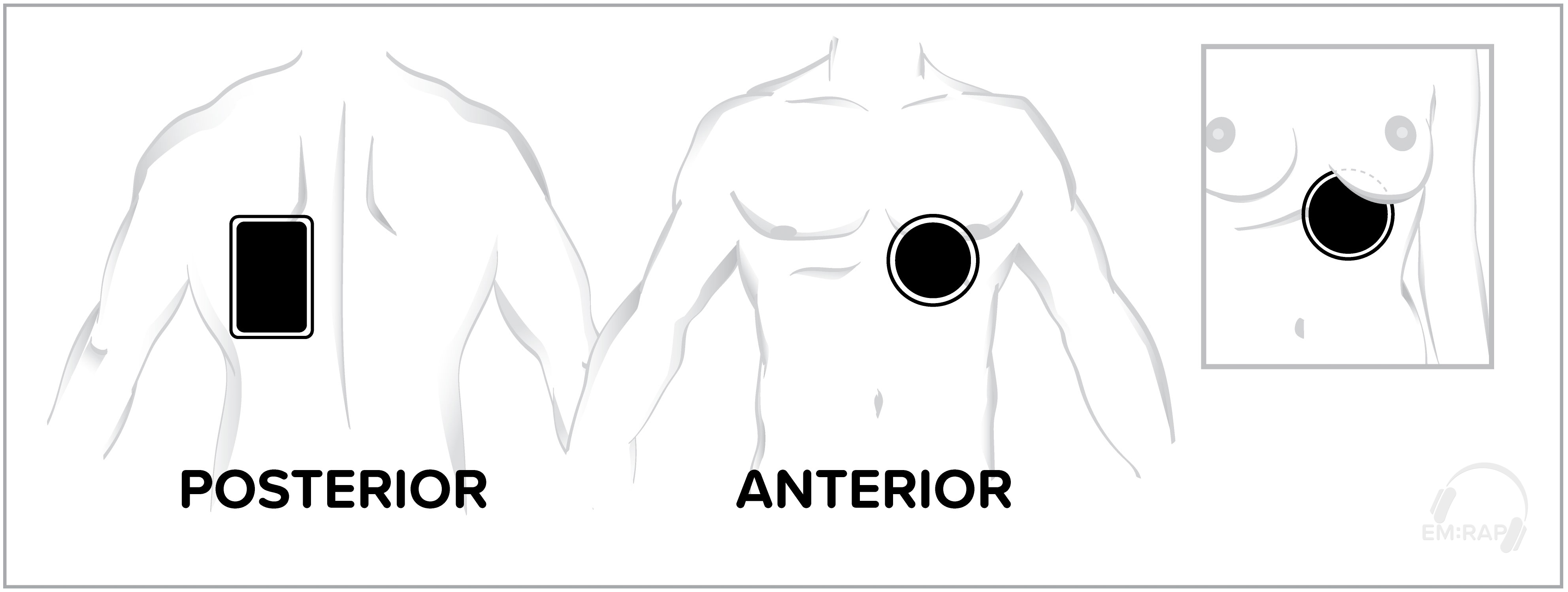 Aed Pad Placement Anteroposterior Placement Jhu Innovations