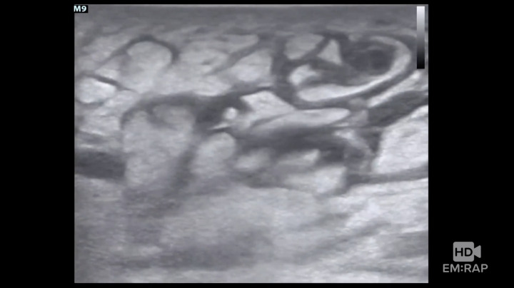 HD - Subcutaneous Tissue Ultrasound | EM:RAP