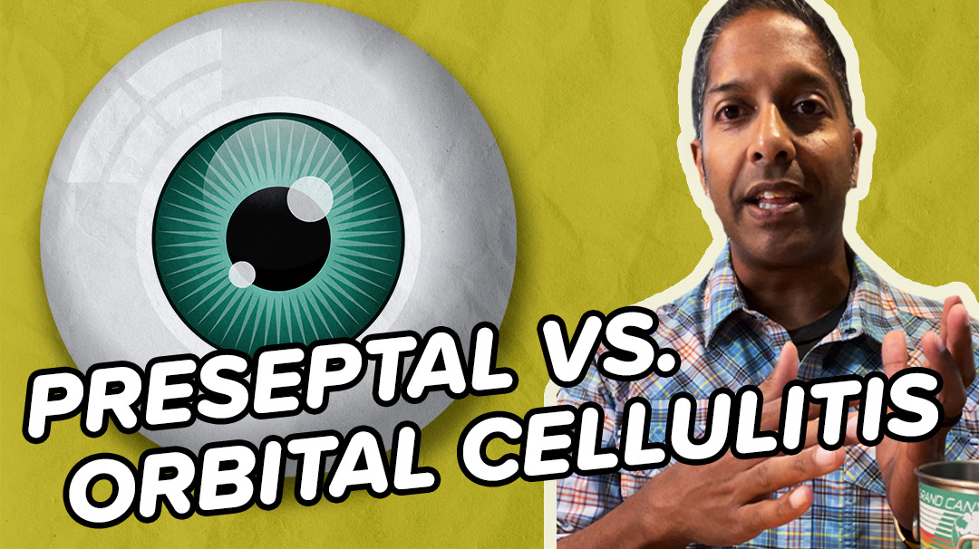 Orbital Cellulitis